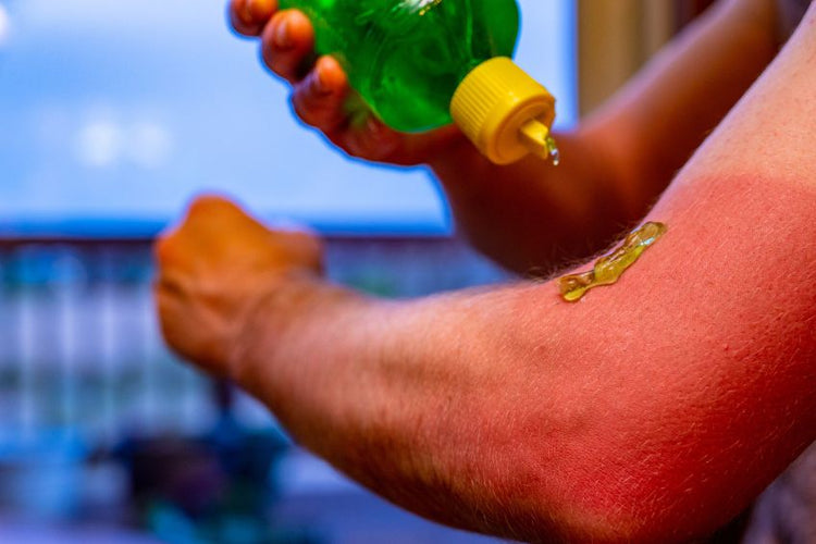 Sunburn Recovery: What to Do When Prevention Fails – Shield-Safety